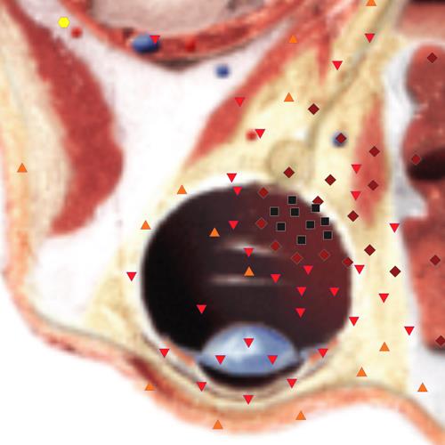Combined NLS-diagnostics of orbital cellulitis | NLS Diagnostic