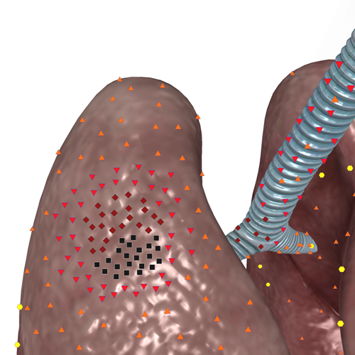 Lung abscesses – multitude of NLS-semiotics | NLS Diagnostic