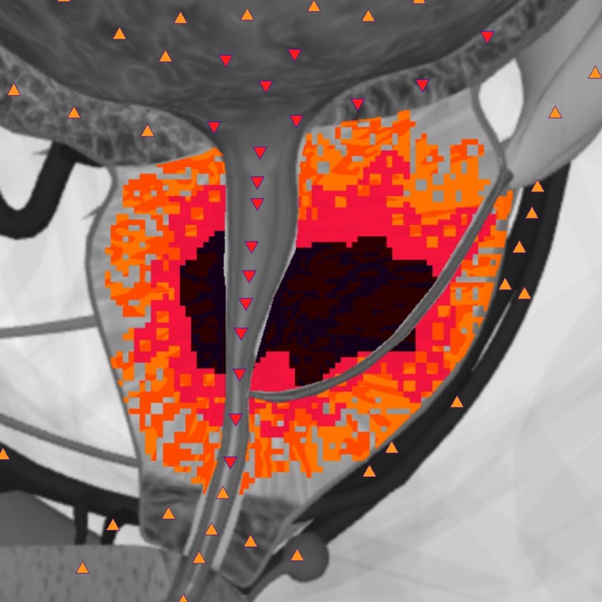 Nonlinear (NLS) diagnostics of prostate gland diseases | NLS Diagnostic